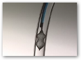 AGA Medical Clinical Trial for Amplatzer Cardiac Plug Begins Enrolling ...
